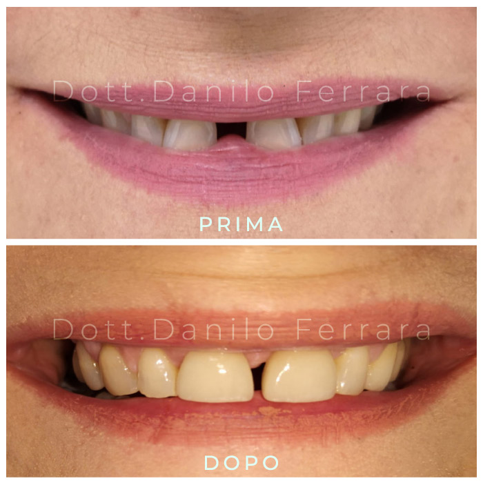 Protesi - SpazioDental