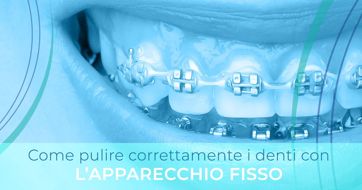 Come pulire correttamente i denti con l'apparecchio fisso - SpazioDental