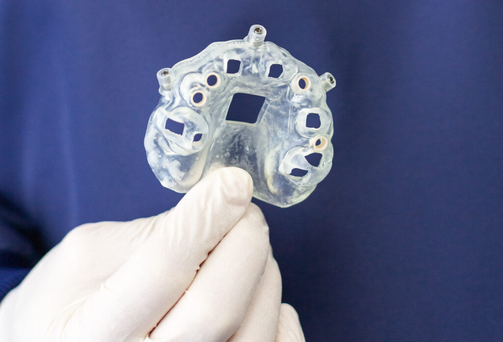 Implantologia computer guidata: le fasi dell'intervento - SpazioDental