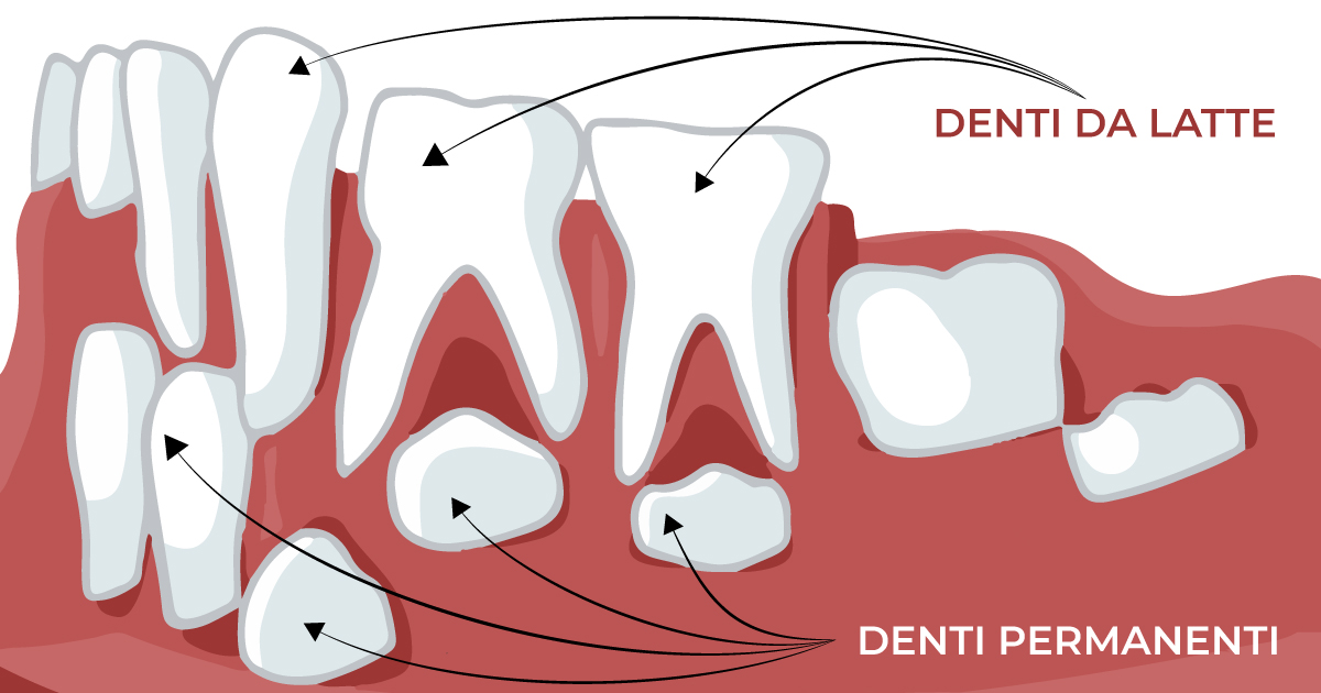 Denti da latte: cosa succede se non cadono - SpazioDental