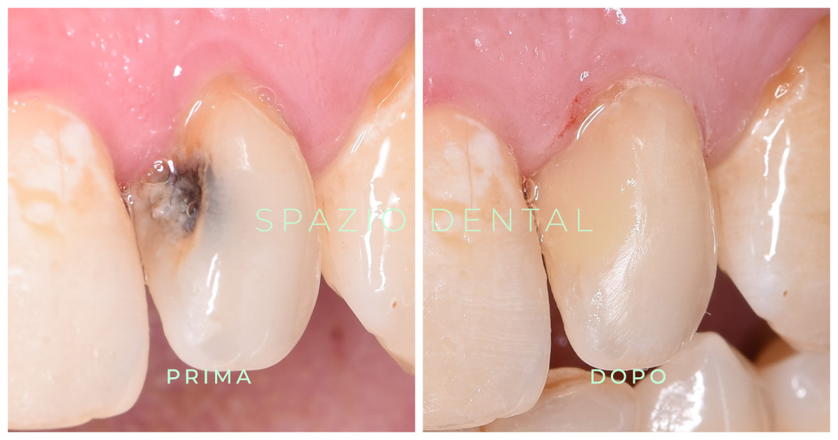Otturazione dentale: tutto ciò che devi sapere - SpazioDental
